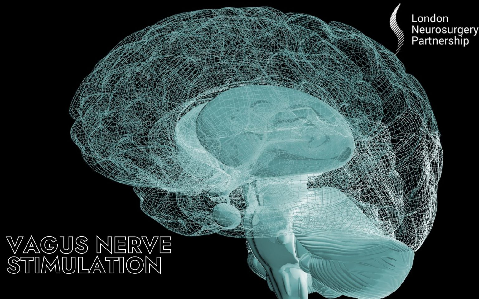Vagus nerve stimulation - London Neurosurgery Partnership Vagus nerve stimulation - London Neurosurgery Partnership